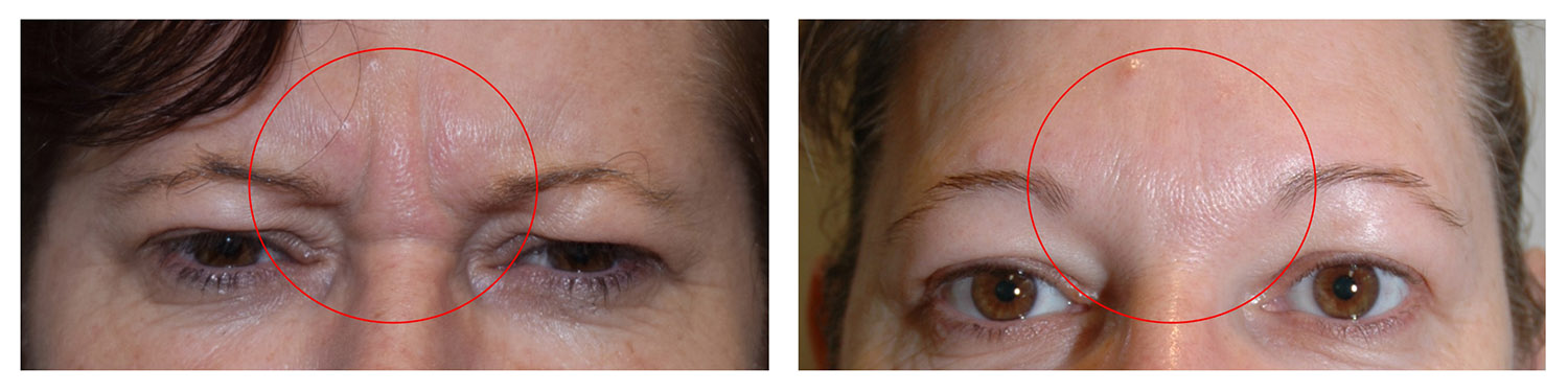 Forehead - Cosmetic Elegance