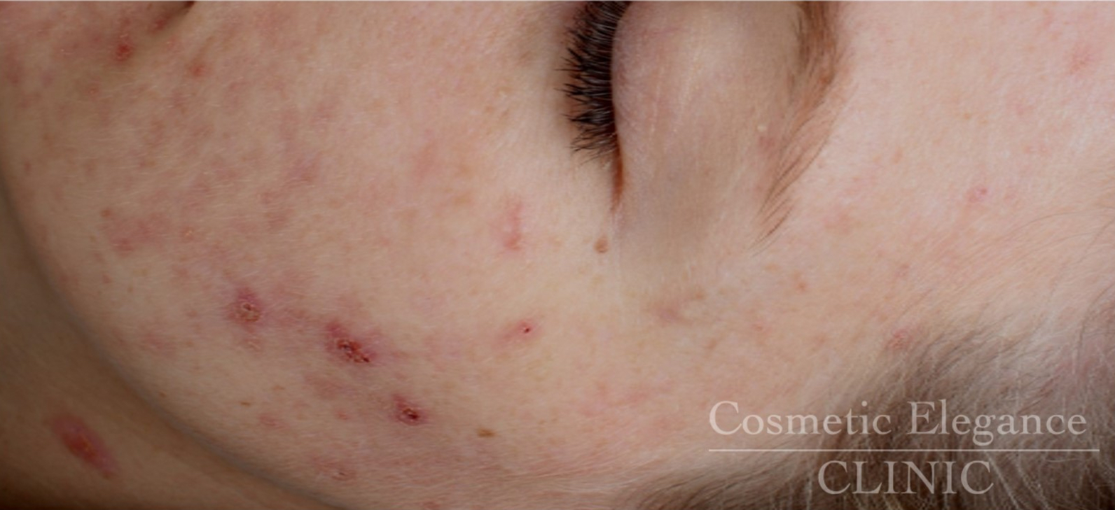 Acne - Dr Ann-Maree - Cosmetic Elegance